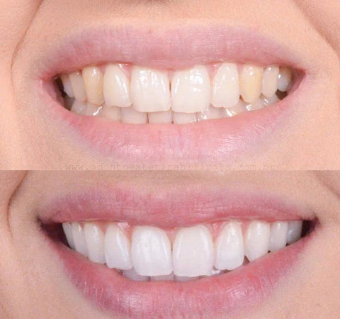 1+1 FREE | Smiley™ - Teeth Whitener – Caedrea